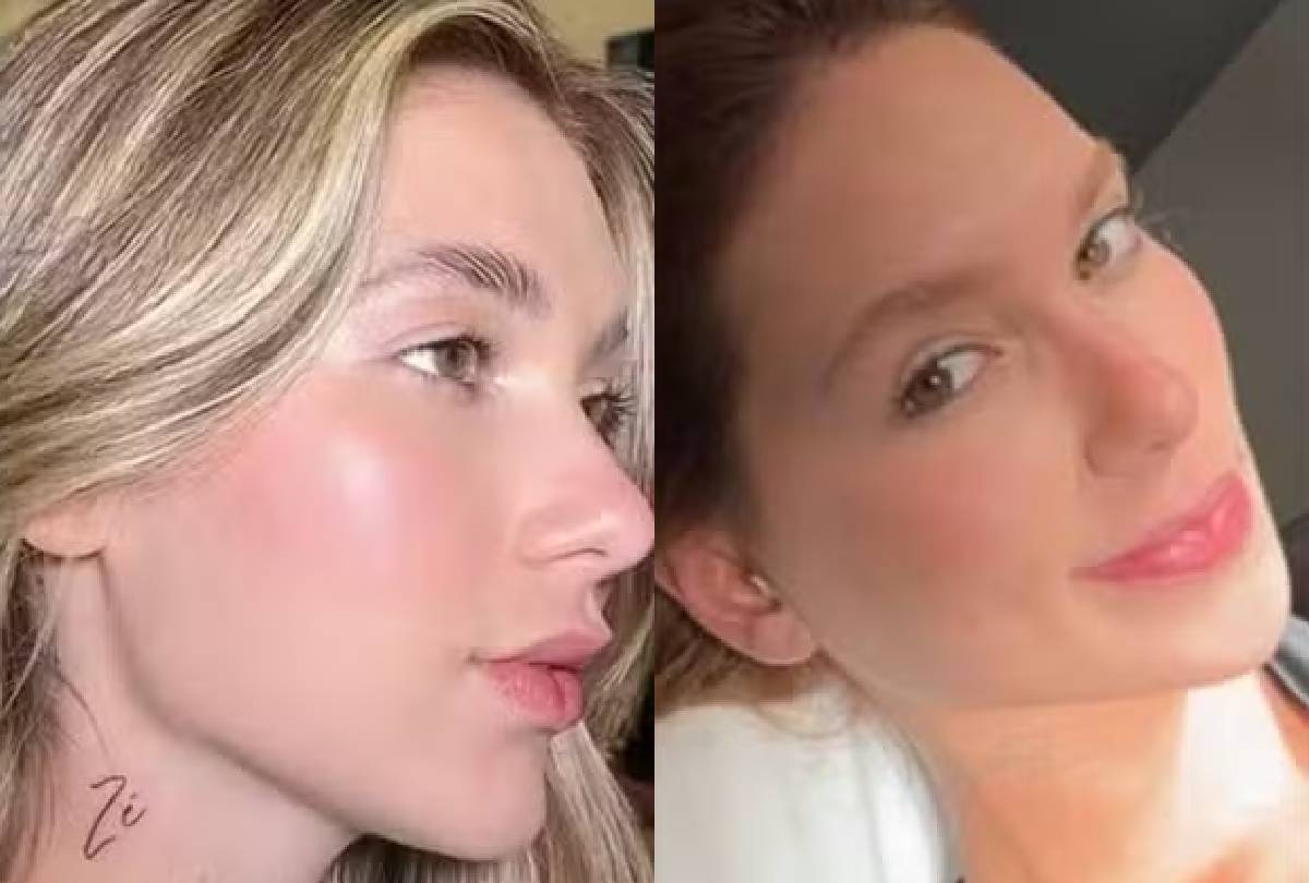 Virgínia remove tatuagem feita para Zé Felipe com laser